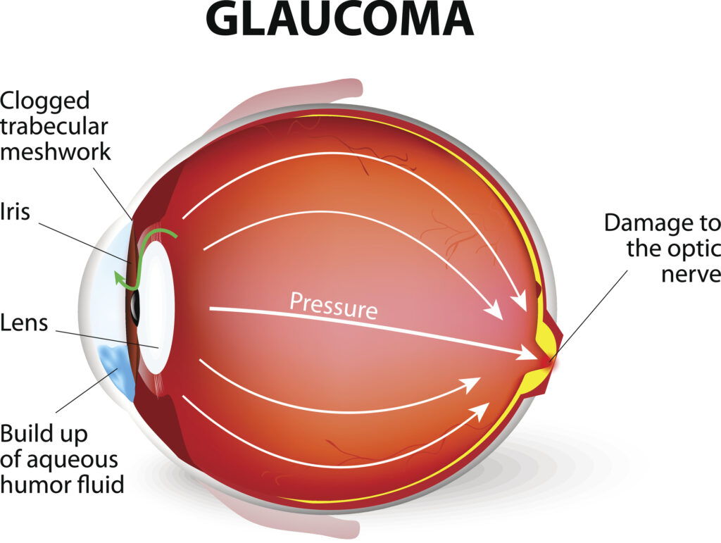 When Is Peripheral Laser Iridotomy Needed for Glaucoma in Reading, PA